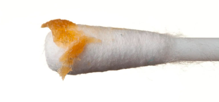 O que saber sobre cerume – Clínica de Otorrino e Otoneuro